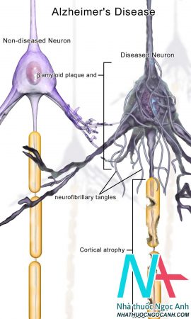 Toàn cảnh về căn bệnh Alzheimer - nhà thuốc Ngọc Anh
