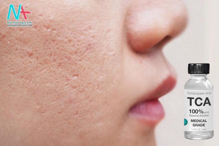 [REVIEW] Chấm TCA là gì? Lời khuyên khi điều trị sẹo bằng chấm TCA