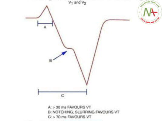 Phân biệt VT và SVT trong điều trị rối loạn nhịp tim