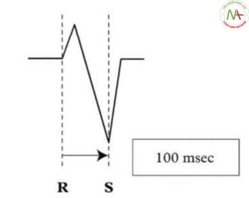 Phân biệt VT và SVT trong điều trị rối loạn nhịp tim