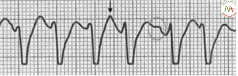 Phân biệt VT và SVT trong điều trị rối loạn nhịp tim