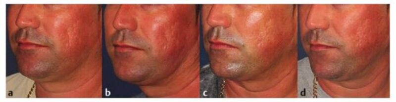 Lăn kim vi điểm và sóng RF trong điều trị mụn, sẹo mụn, trẻ hóa da