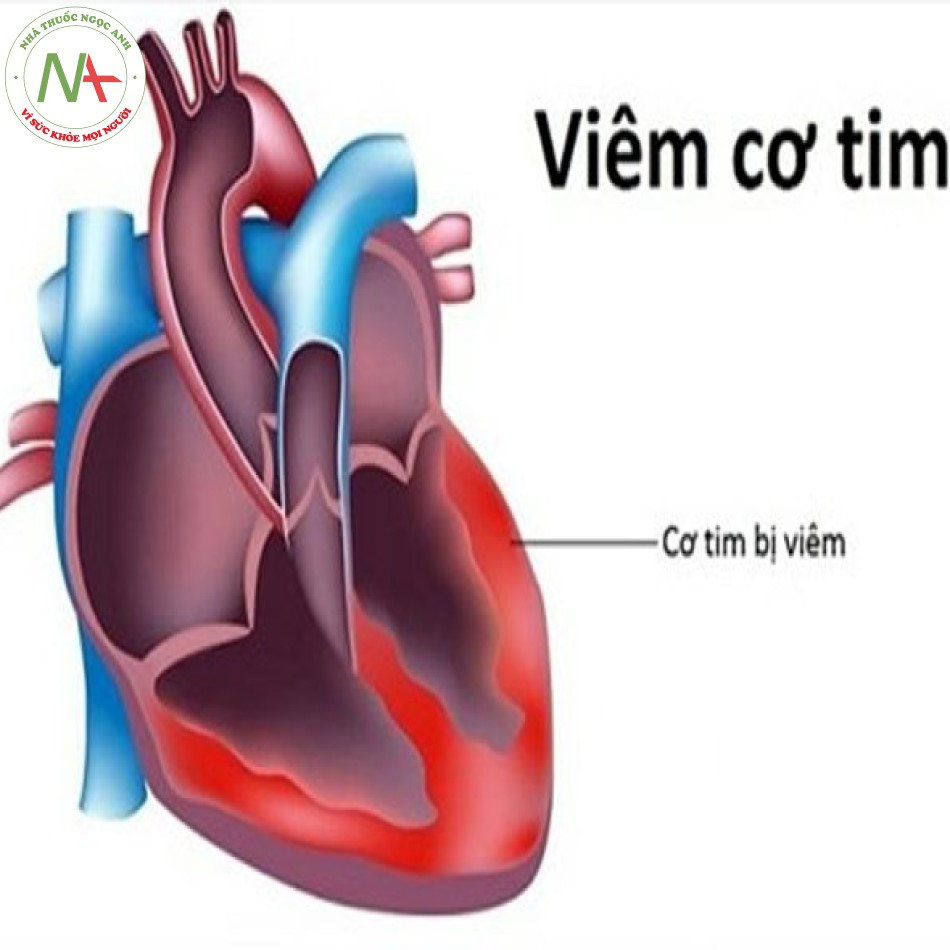 Viêm Cơ Tim Ở COVID-19 Có Biểu Hiện Sốc Tim: Một Loại Trường Hợp