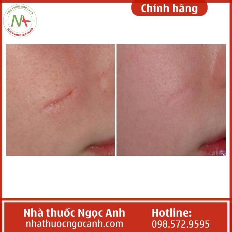 Kem trị sẹo Scar Esthetique có tốt không, giá bao nhiêu, bán ở đâu