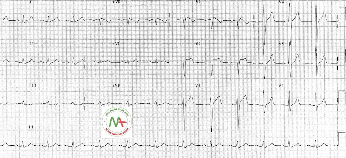 Hội chứng Brugada ( lịch sử, dịch tế, chẩn đoán, quản lý)