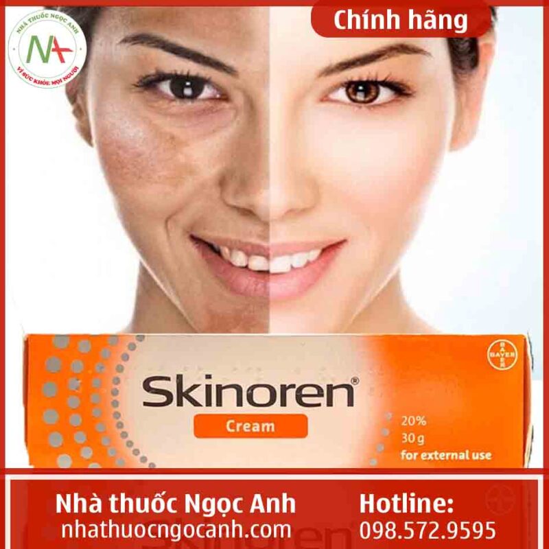 Skinoren Cream có đẩy mụn không, giá bao nhiêu, mua ở đâu chính hãng?