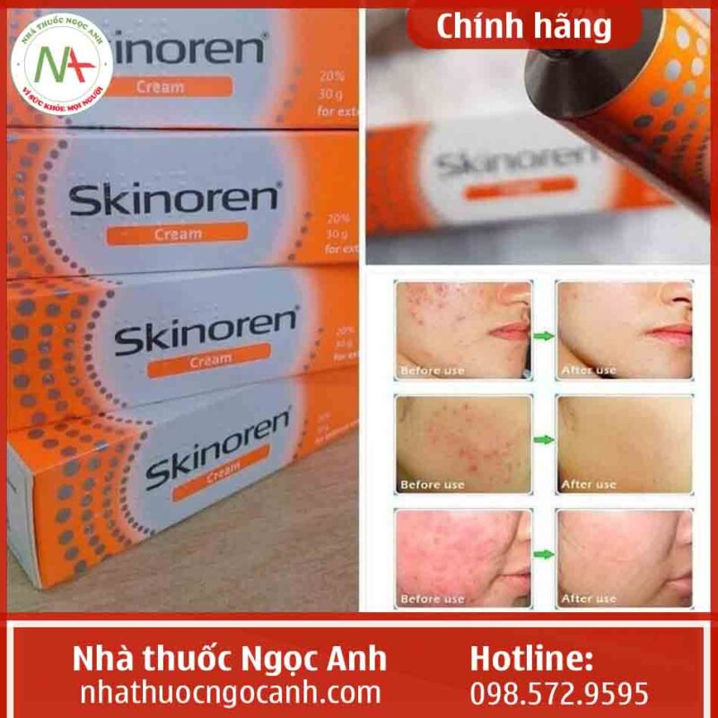 Skinoren Cream có đẩy mụn không, giá bao nhiêu, mua ở đâu chính hãng?