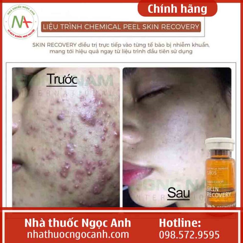 Peel Skin recovery Inno cách sử dụng, giá bao nhiêu, mua ở đâu?