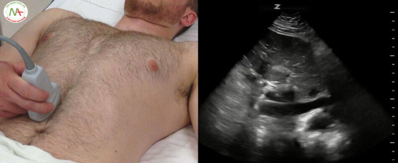 Rapid Ultrasound for Shock and Hypotension - Siêu âm nhanh trong sốc và ...