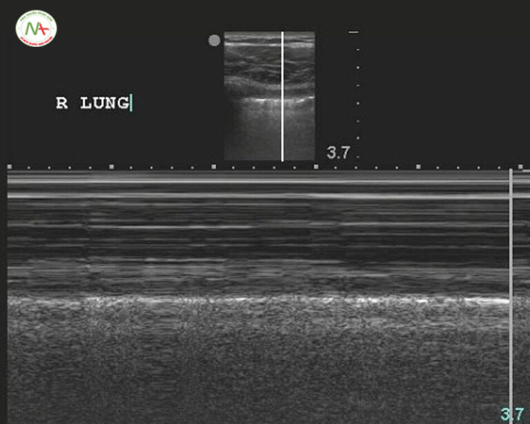 Rapid Ultrasound for Shock and Hypotension - Siêu âm nhanh trong sốc và ...
