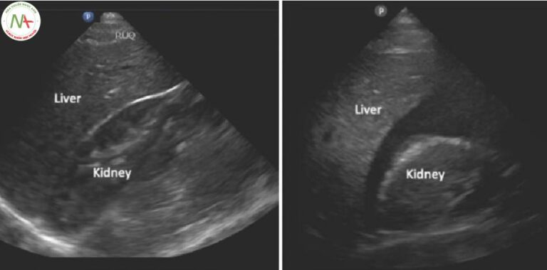 Shock protocols trong siêu âm tim khi cấp cứu