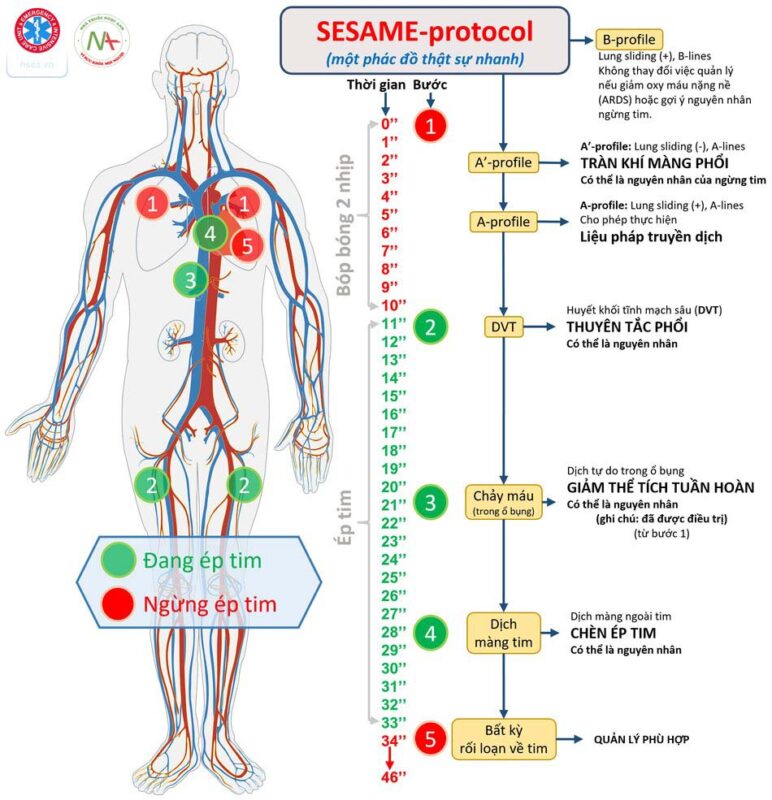 SESAME protocol và POCUS-CA siêu âm tại chỗ trong ngừng tim