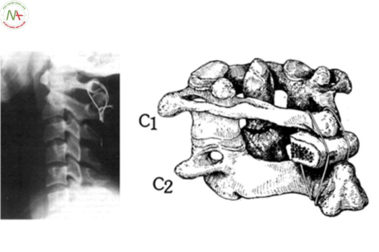 Các phương pháp điều trị phẫu thuật tổn thương mất vững cột sống cổ cao