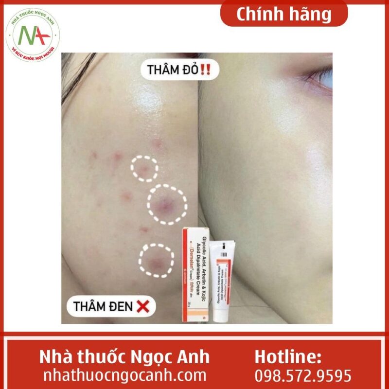 Demelan Cream Glenmark công dụng, review, giá bao nhiêu, mua ở đâu