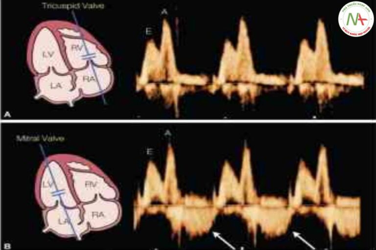 Các kỹ thuật Doppler phổ và hình ảnh tim thai trong Doppler phổ