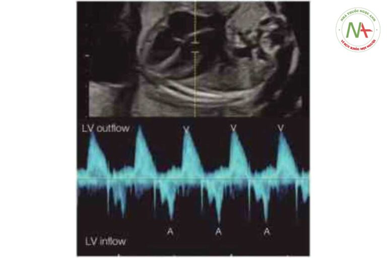 TỔNG QUAN VỀ RỐI LOẠN NHỊP TIM THAI (FETAL ARRHYTHMIAS)