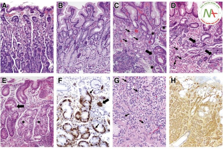 VIÊM TEO DẠ DÀY: CHẨN ĐOÁN, QUẢN LÝ VÀ THEO DÕI - Hội tiêu hoá Hoa Kỳ